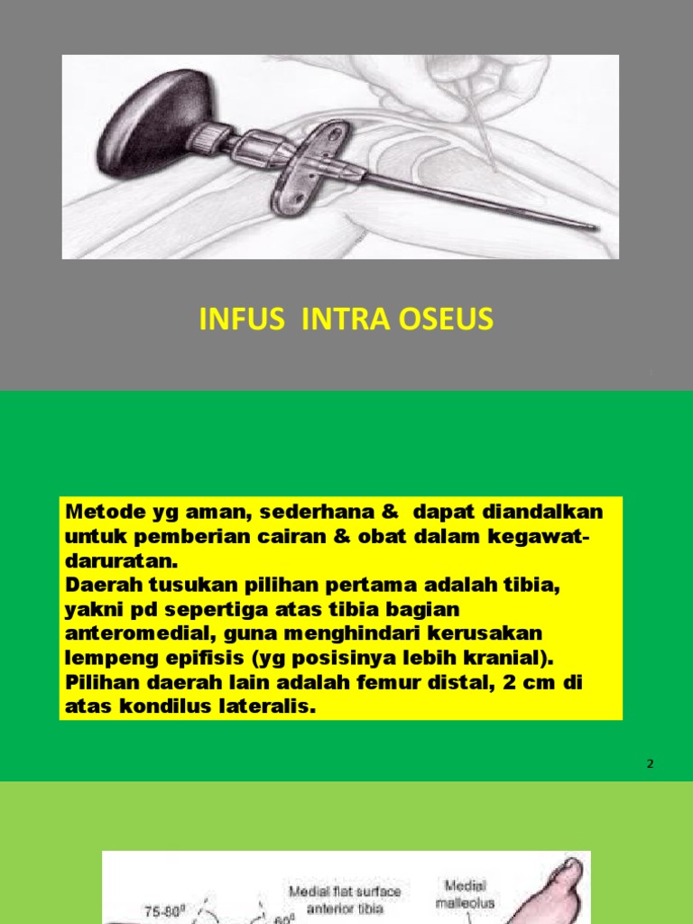 Infus Intraoseus: Panduan Praktis | PDF