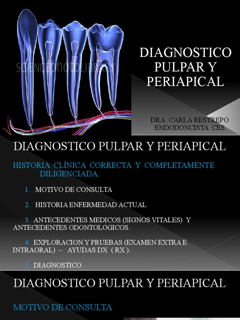 Diagnóstico pulpar y periapical: una guía para la identificación de las condiciones de la pulpa ...