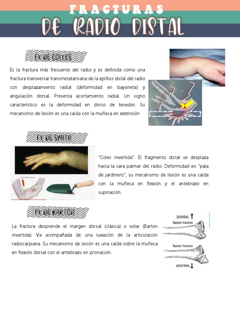 Fractura de radio distal y deformidades | PDF