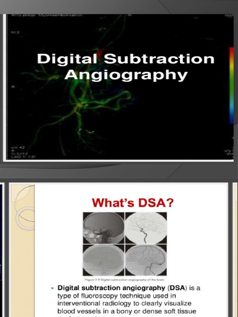 Dsa | Download Free PDF | Interventional Radiology | Radiology Dsa | Download Free PDF | Interventional Radiology | Radiology