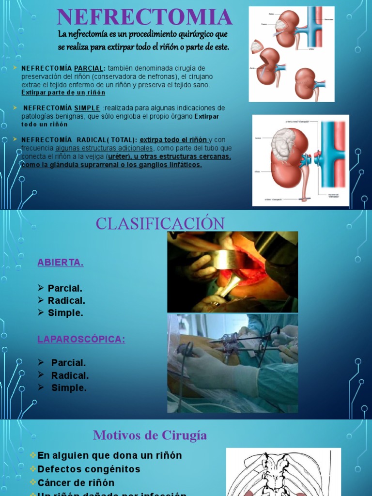 NEFRECTOMÍA | PDF | Riñón | Especialidades Medicas