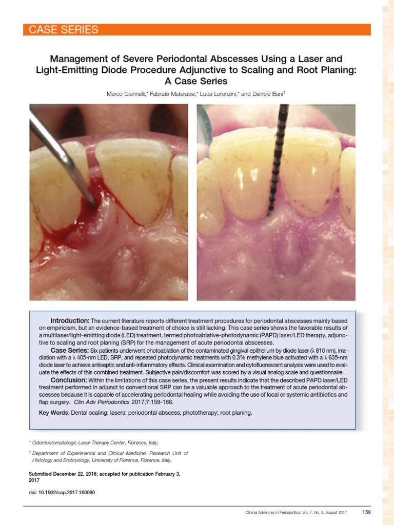 Management of Severe Periodontal Abscesses Using A Laser andLight ...
