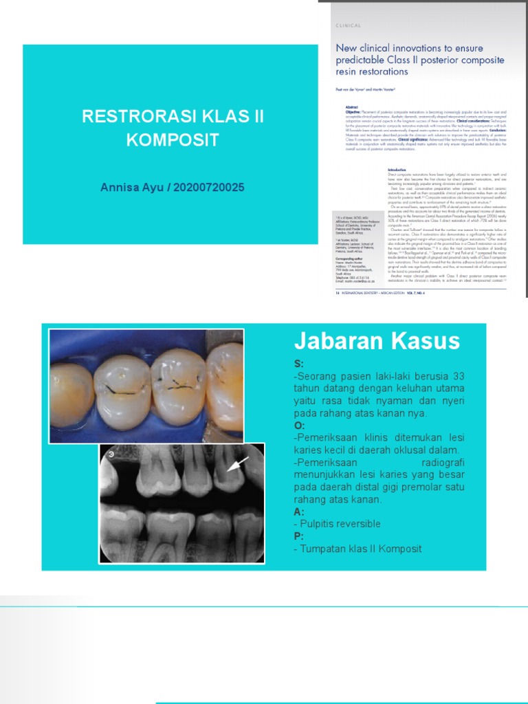 Restorasi Kelas II Komposit: Teknik dan Keberhasilan | PDF | Griya & Taman | Sains & Matematika