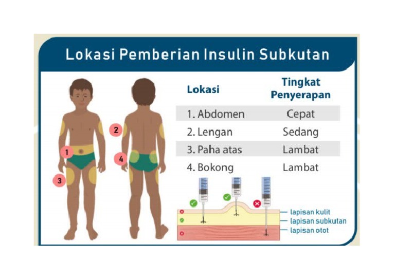 3 Lokasi Pemberian Insulin | PDF