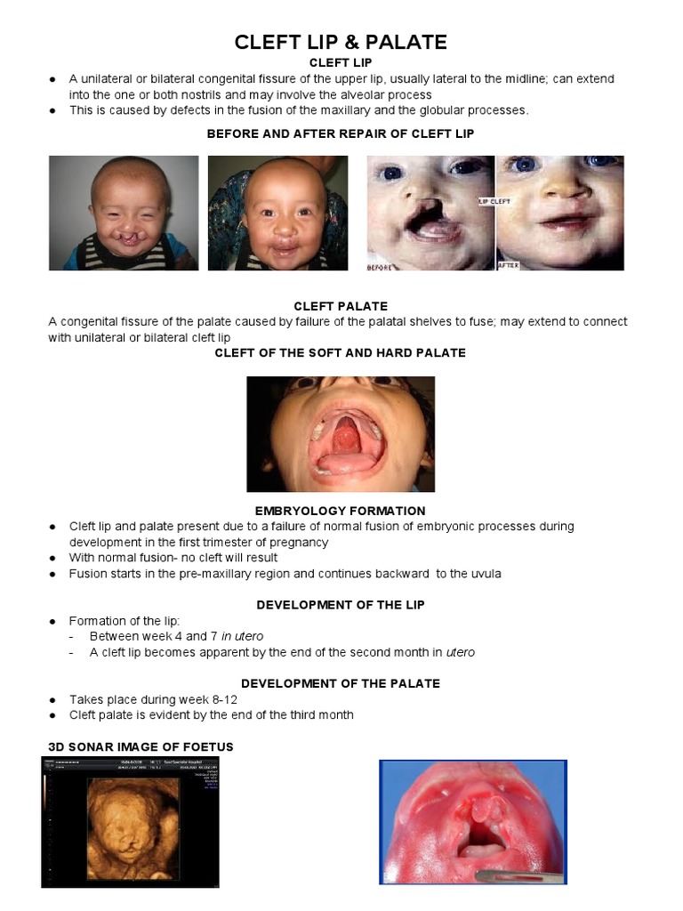 Cleft Lip & Palate | PDF | Oral Hygiene | Mouth