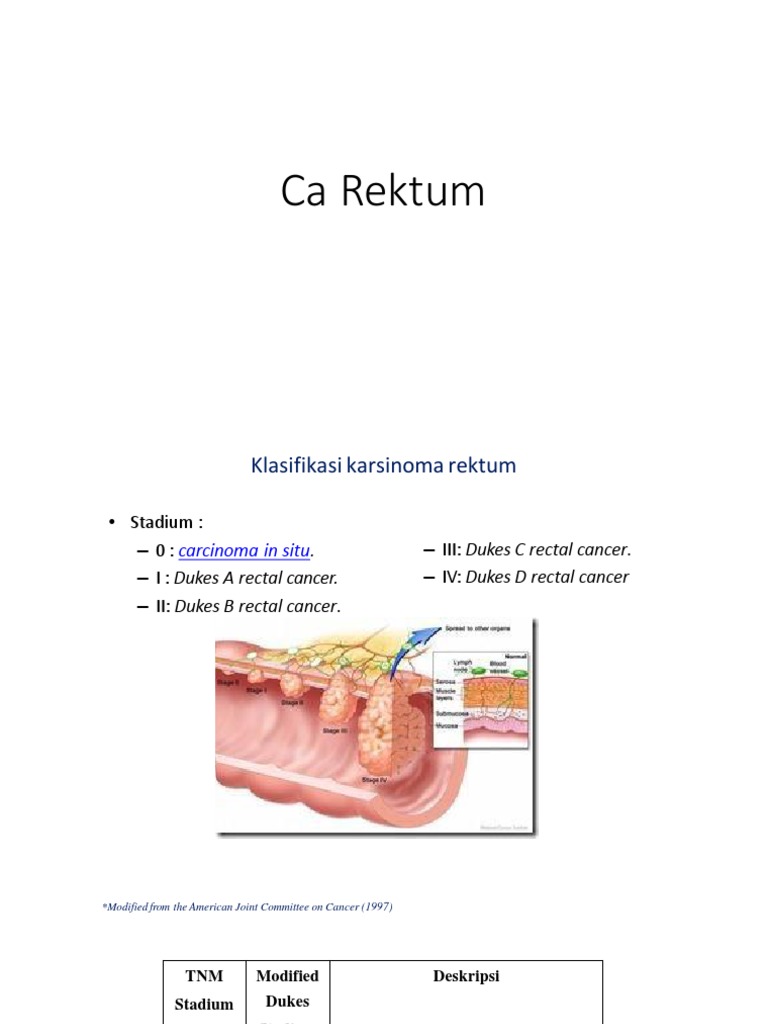 Ca Rektum | PDF