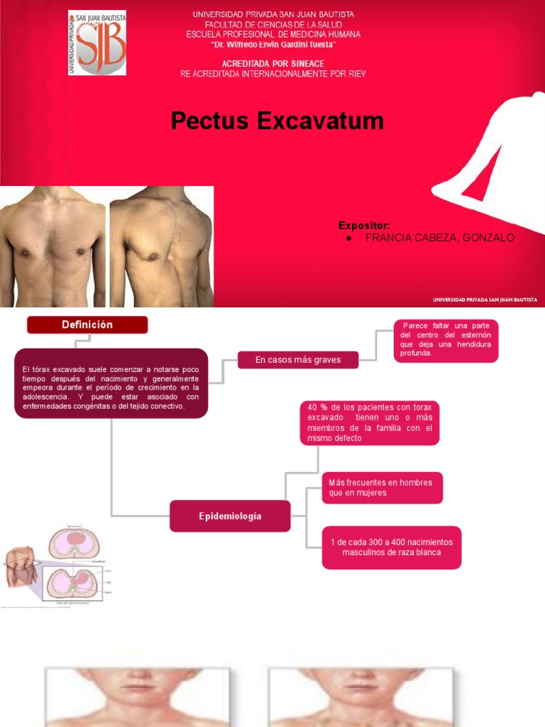 Pectun Excavatum | PDF | Especialidades Medicas | Medicina CLINICA