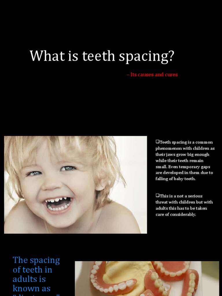 What Is Teeth Spacing?: - Its Causes and Cures | PDF | Tooth ...