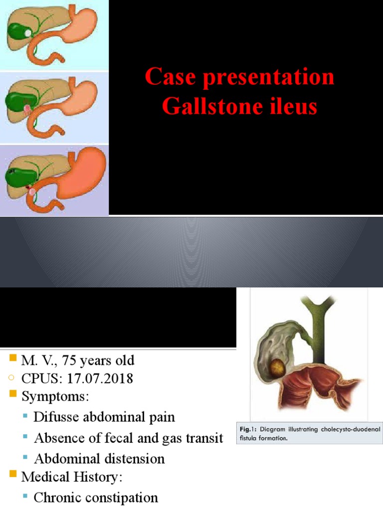 Case Presentation Gallstone Ileus | PDF | Gastroenterology | Digestive ...