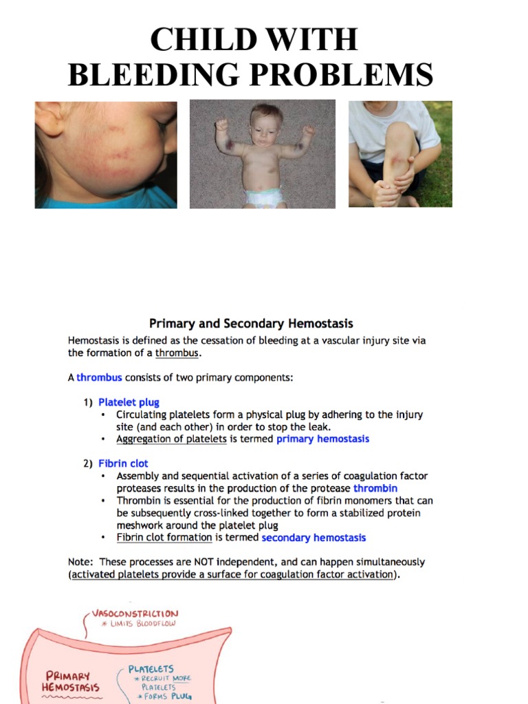 Child With Bleeding Problems Shasha | PDF | Coagulation | Haemophilia