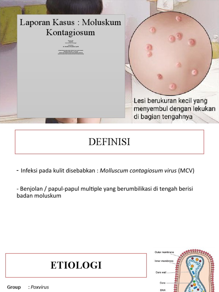 Che Wan Muhammad Azmi - 112018199 - Presentasi Kasus-Moluskum Kontagiosum | PDF