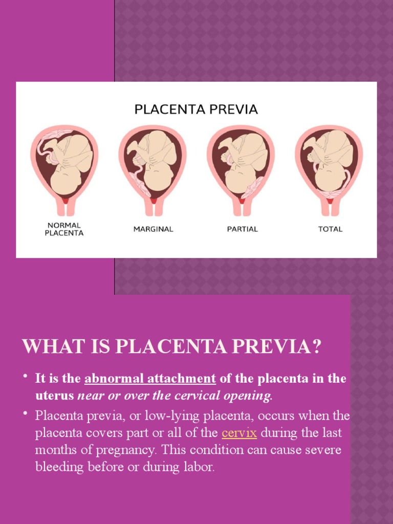 Placenta Previa | PDF | Bleeding | Childbirth