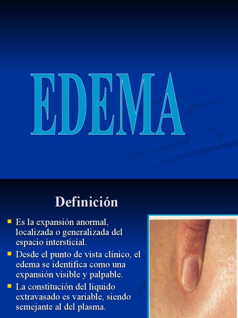 EDEMA Semiologia | PDF | Edema | Rtt