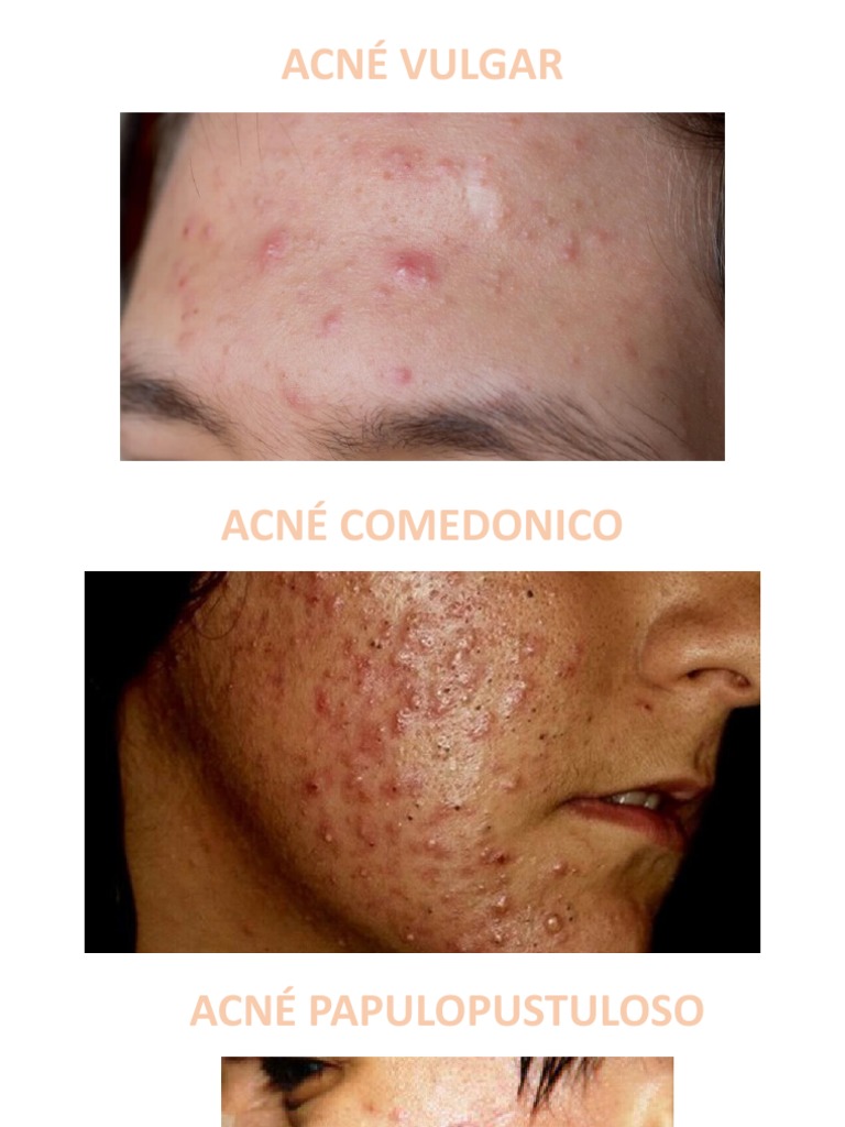 Tipos de Acné | PDF