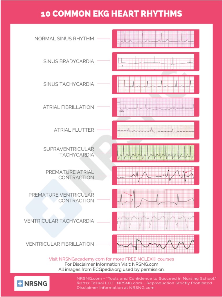 Cardiac 1.02 10 Common EKG Heart Rhythms | PDF