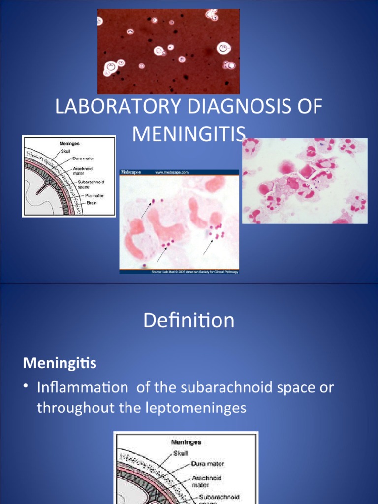 Laboratory Diagnosis of Meningitis | PDF | Meningitis | Pneumonia