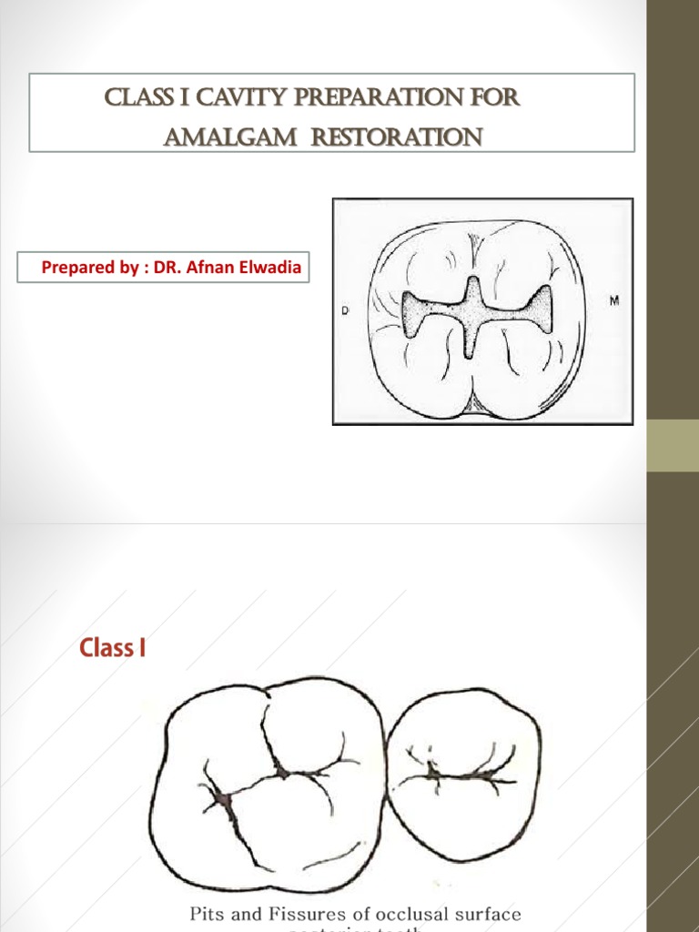 Class I Cavity Preparation For Amalgam Restoration: Prepared By: DR ...