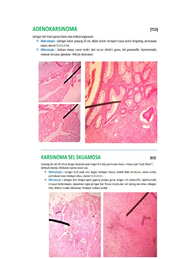 Karsinoma Verukosa | PDF