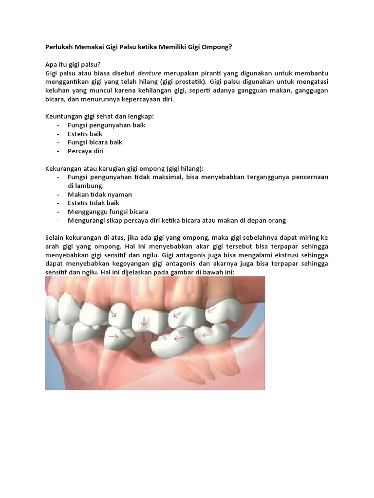 Perlukah Memakai Gigi Palsu Ketika Memiliki Gigi Ompong | PDF