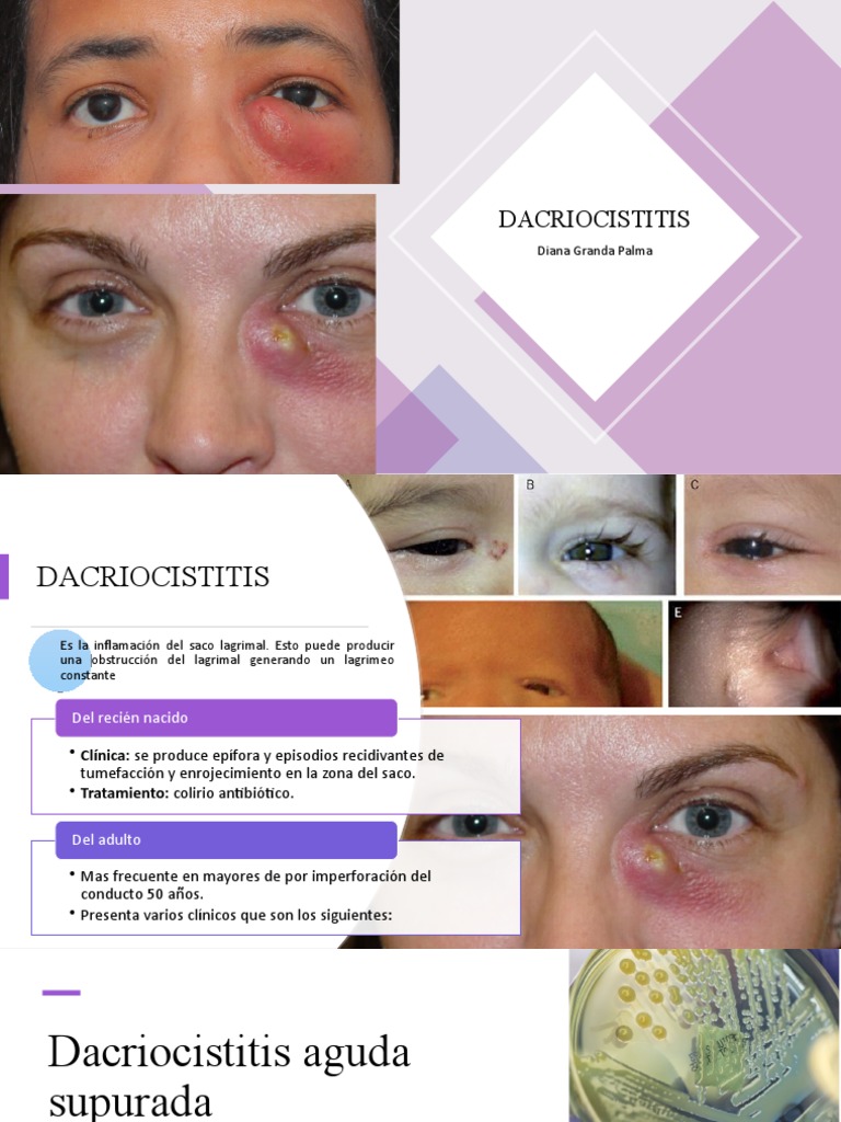 Dacriocistitis Oftalmo | PDF | Inflamación | Rtt