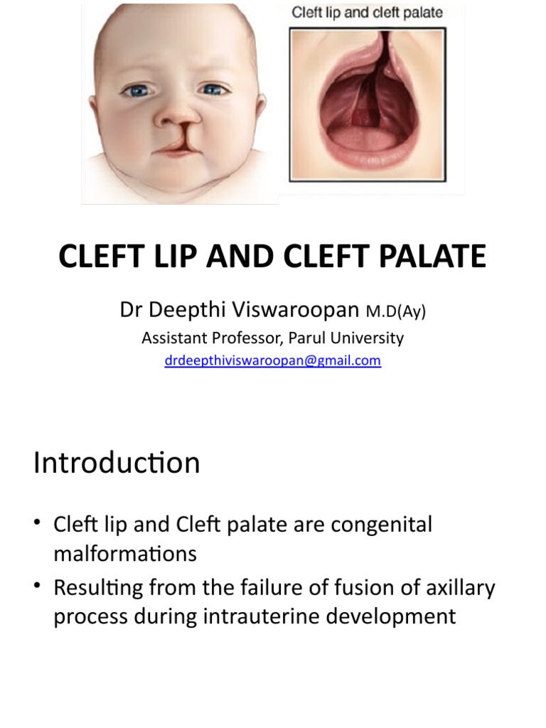 Causes, Types, Pathophysiology and Management of Cleft Lip and Cleft Palate | PDF | Human Nose ...