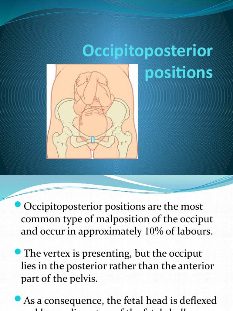 Occipitoposterior Positions | PDF | Pelvis | Childbirth