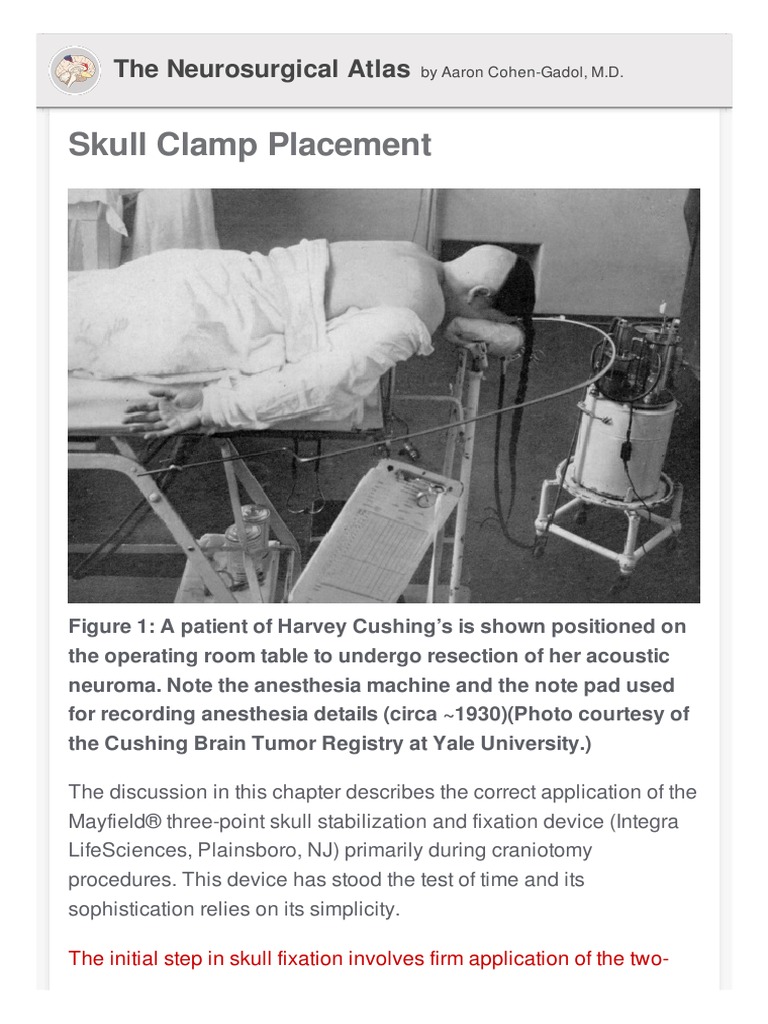 Skull Clamp Placement: The Neurosurgical Atlas | PDF | Skull ...