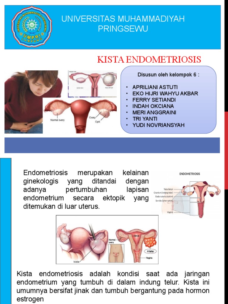 Kista Endometriosis: Penyebab dan Pengobatan | PDF