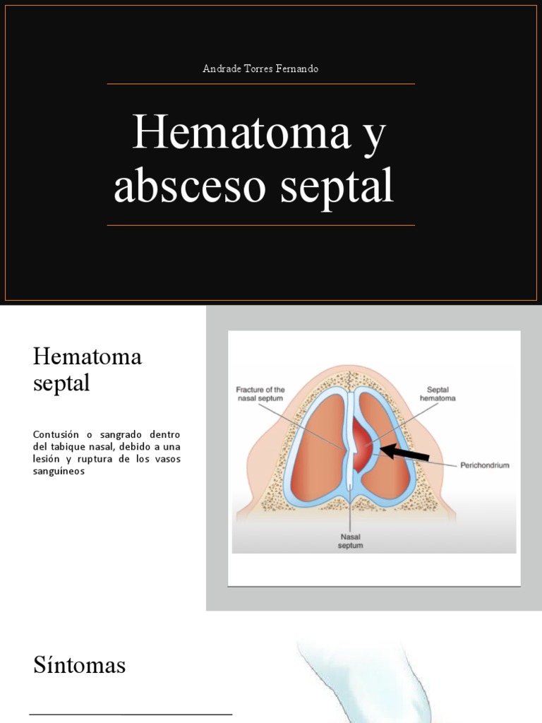 Hematoma y Absceso Septal | PDF