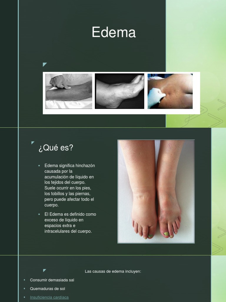 Edema | PDF | Edema | Sistema linfático