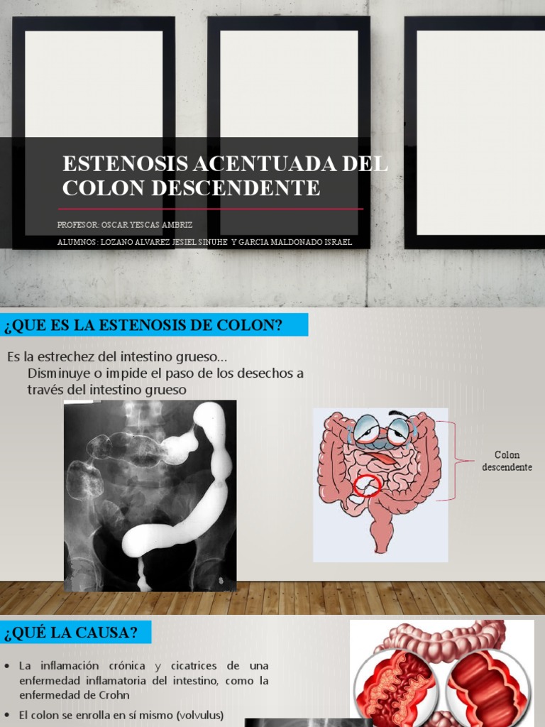 Estenosis Acentuada Del Colon Descendente | PDF