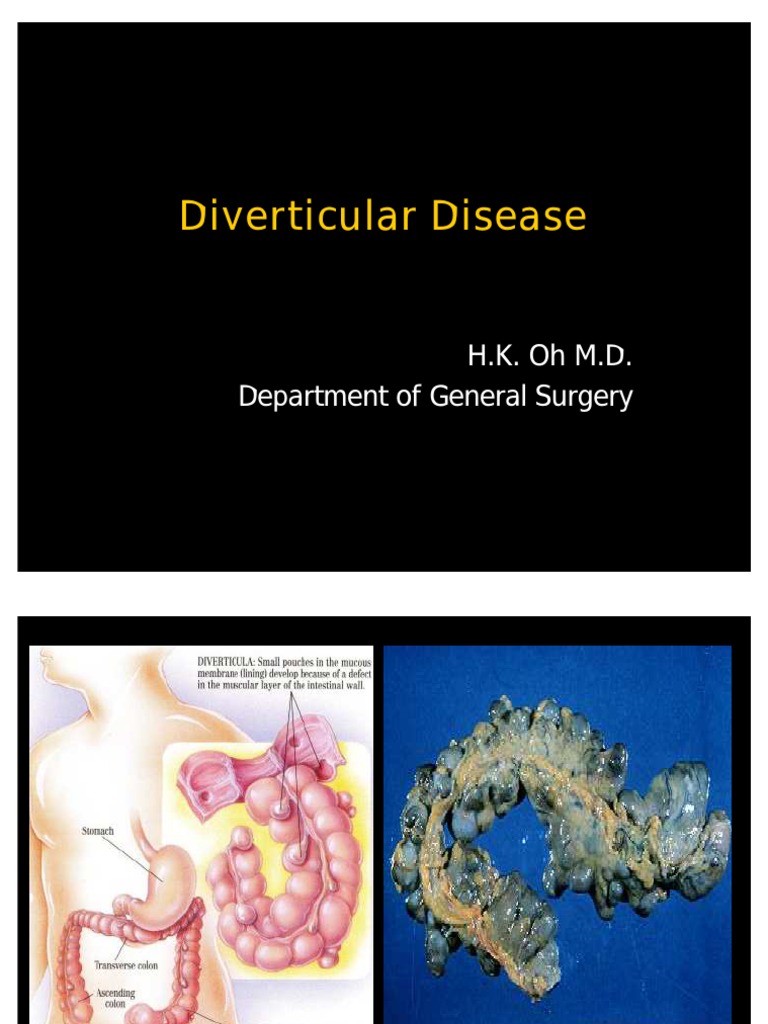 Diverticulitis | Epidemiology | Medical Specialties