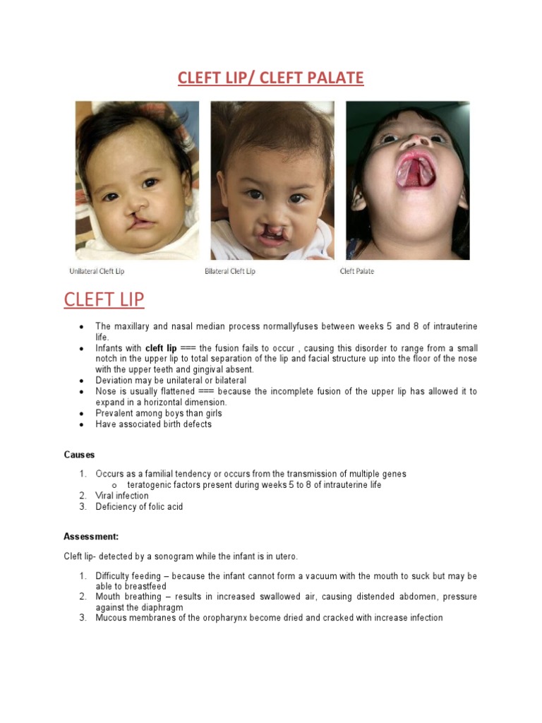 Cleft Lip Palate | PDF | Human Head And Neck | Facial Features