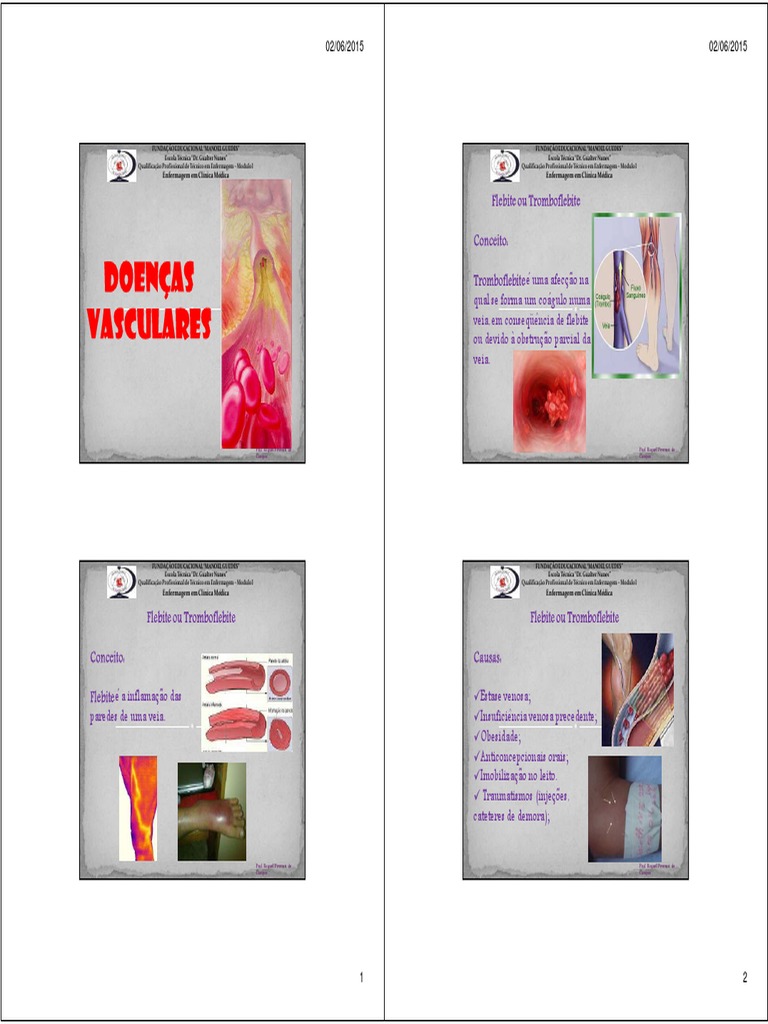 Flebite e Tromboflebite: Conceitos, Causas, Sintomas, Tratamento e ...