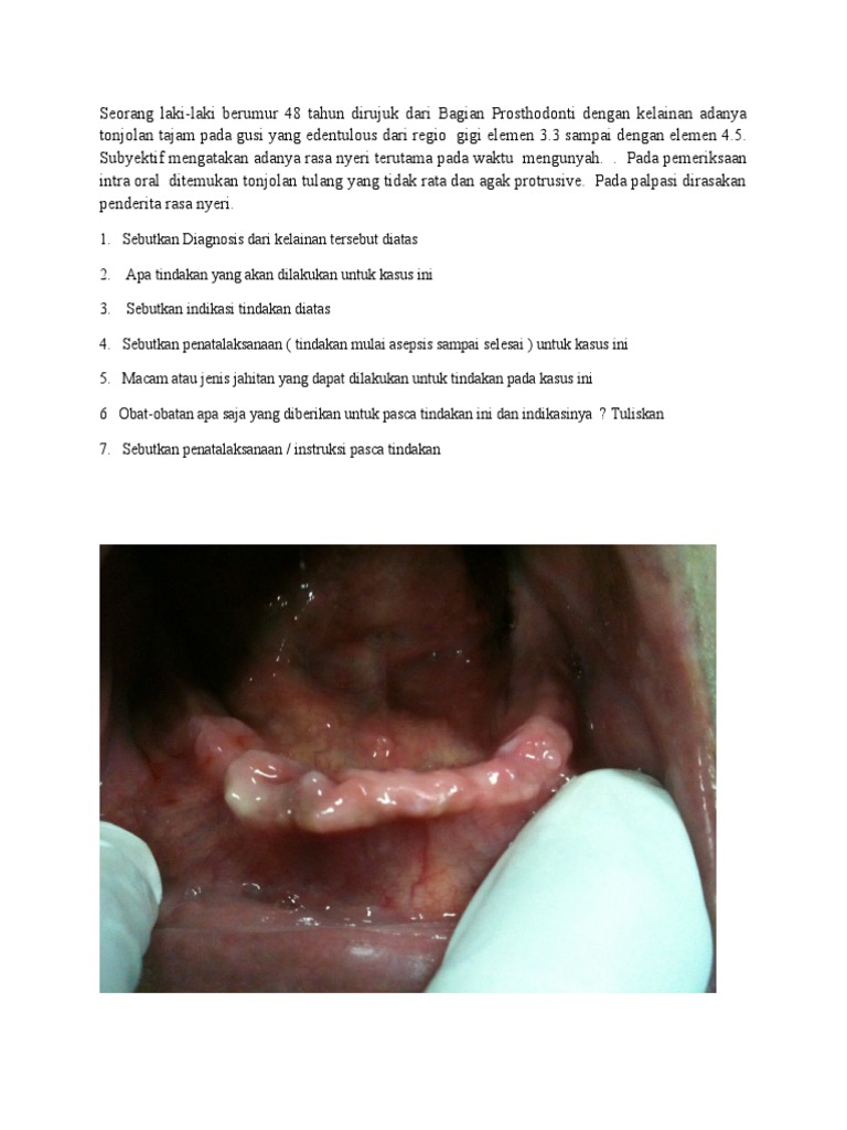 Soal OSCE - Bedah Mulut Alveolektomi | PDF