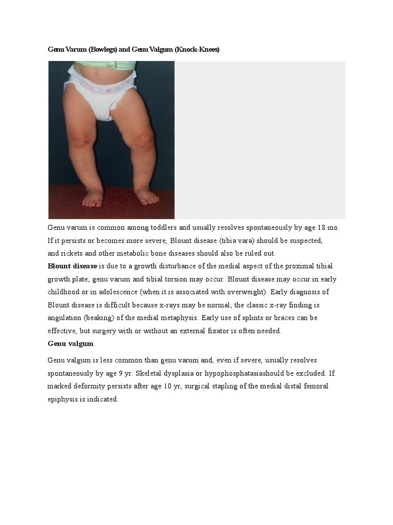 Genu Varum (Bowlegs) and Genu Valgum (Knock-Knees) | PDF