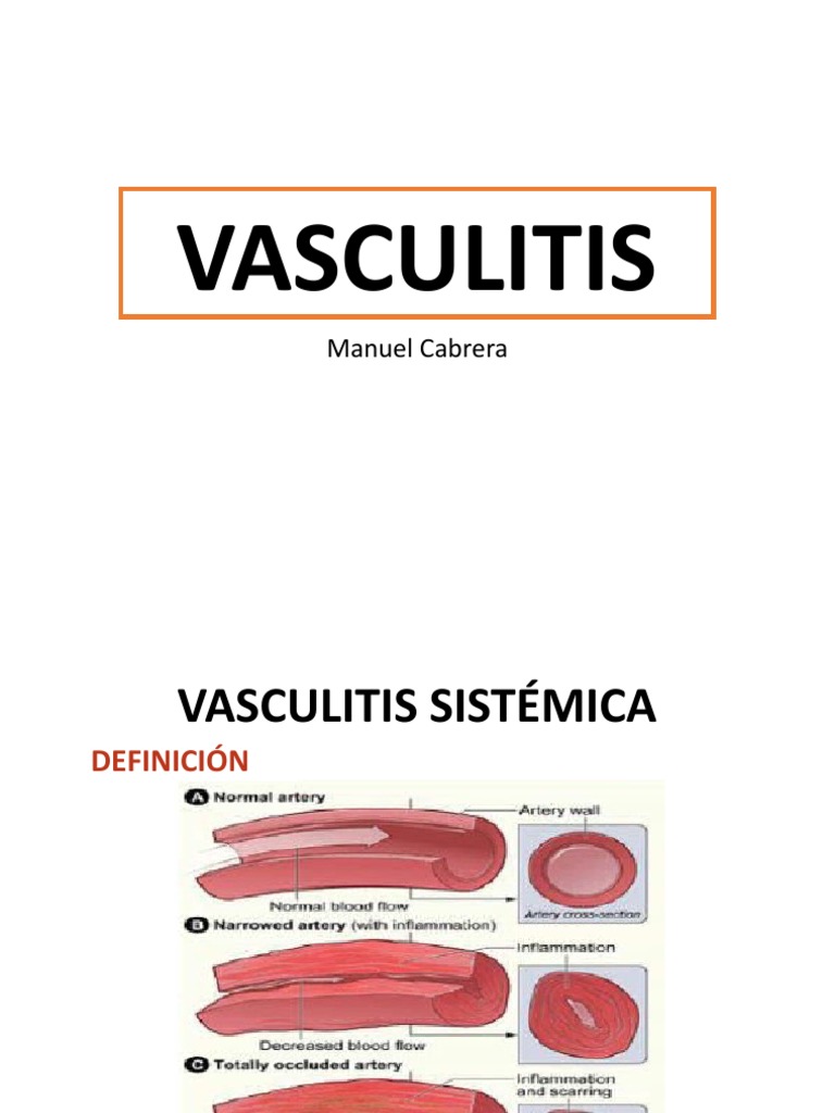 Vasculitis | PDF | Medicina CLINICA | Inmunología