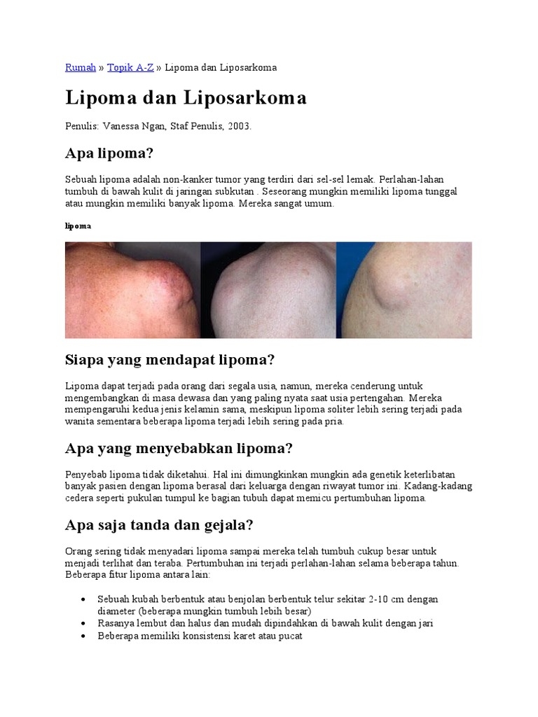 Lipoma | PDF