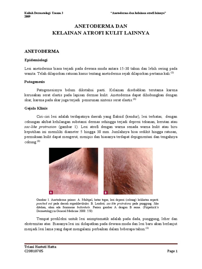 Anetoderma Dan Kelainan Atrofi Kulit Lainnya | PDF | Pengelolaan ...