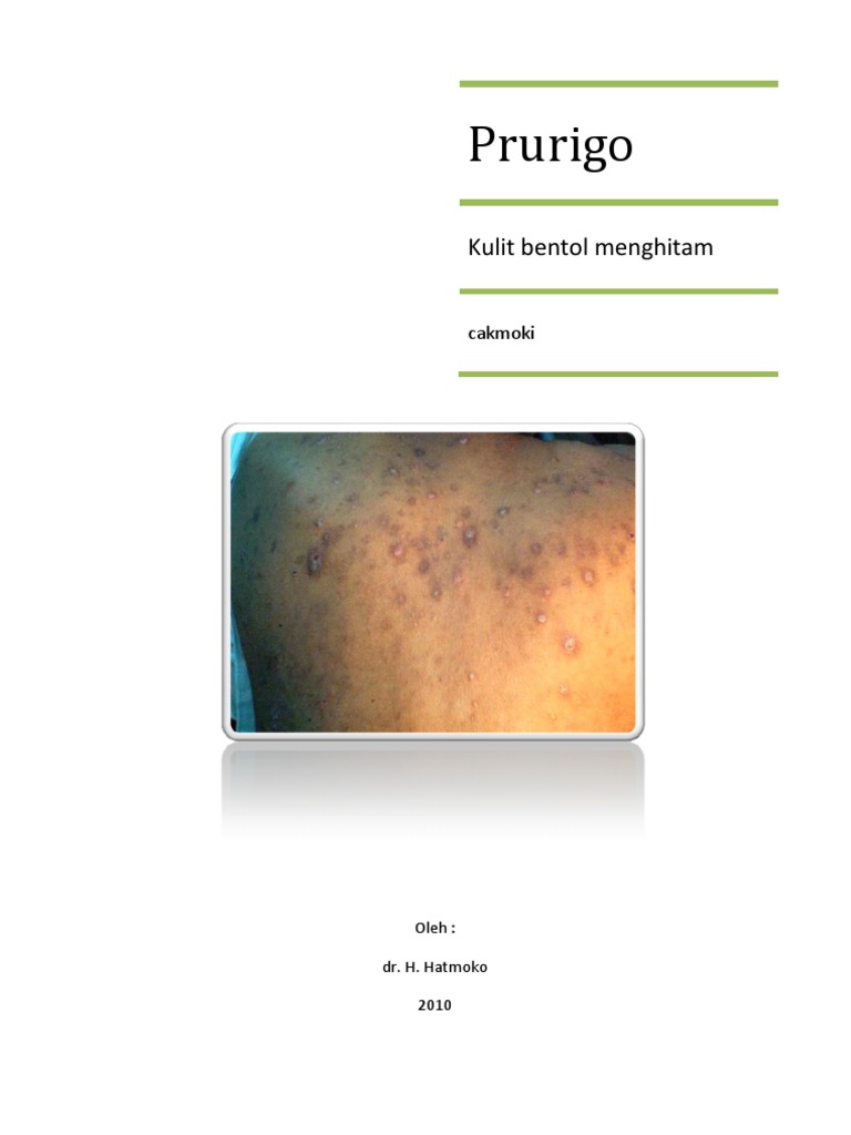 Prurigo | PDF