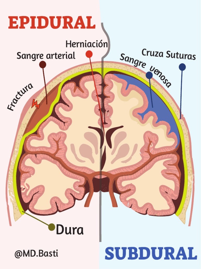 Epidural VS Subdural2 | PDF | Lesión | Enfermedades y trastornos humanos
