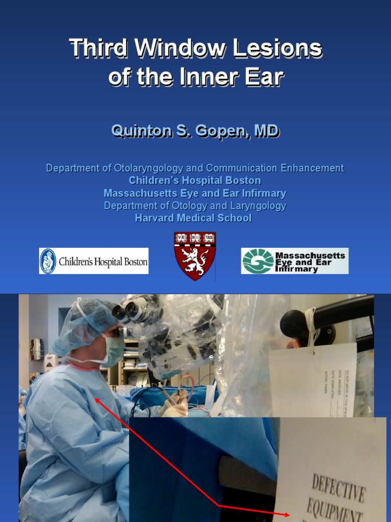 Third Window Lesions of The Inner Ear Quinton Gopen 9-30-09 | PDF | Ear ...