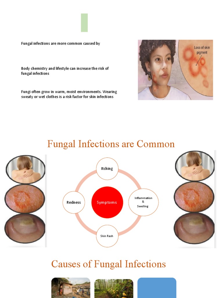Fungal Infections Are More Common Caused by | PDF | Dermatology | Skin