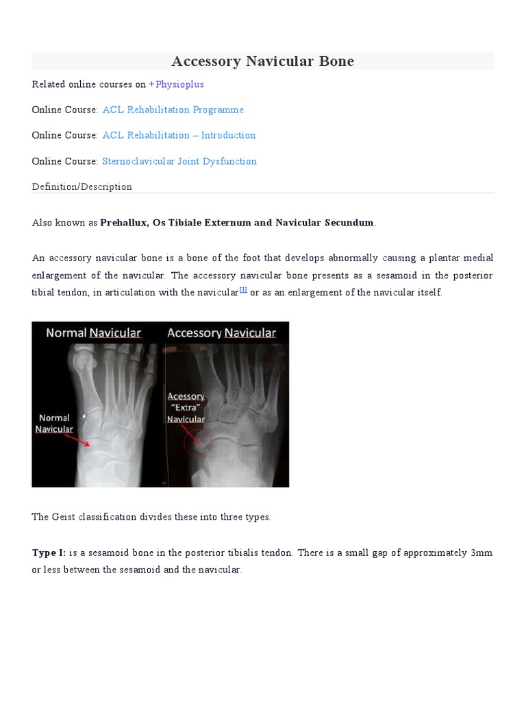Accessory Navicular Bone | PDF | Foot | Ankle