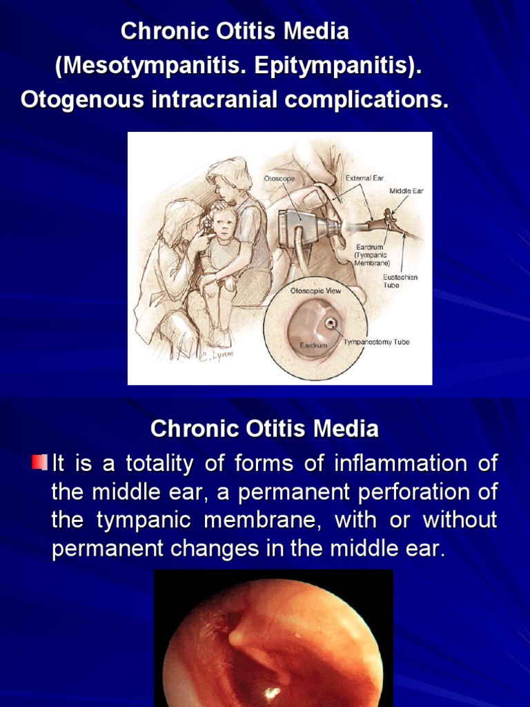 Chronic Otitis Media (Mesotympanitis. Epitympanitis) - Otogenous Intracranial Complications ...