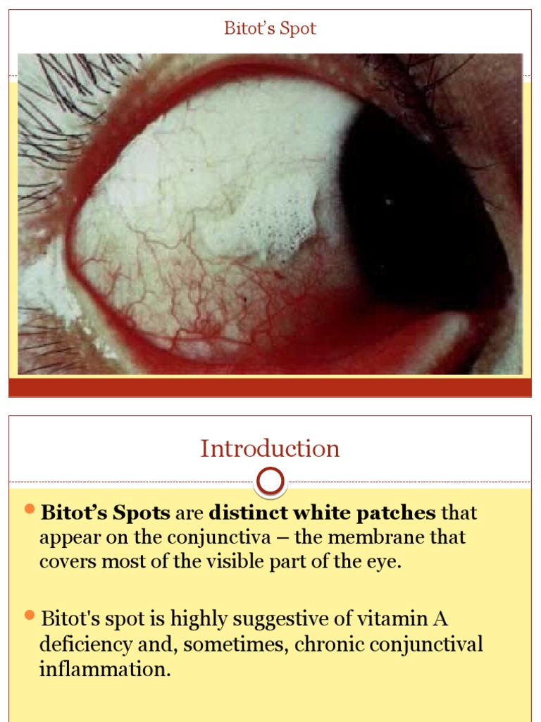 Bitot's Spot | PDF | Vitamin A | Vitamin