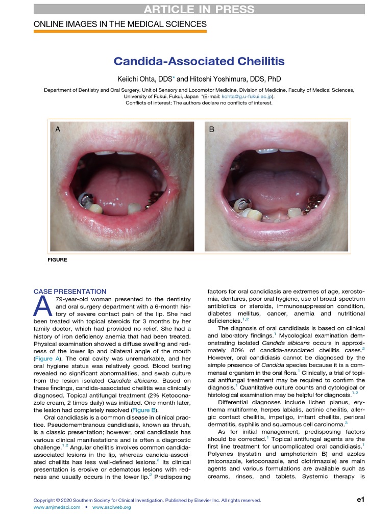 Candida-Associated Cheilitis: Online Images in The Medical Sciences ...