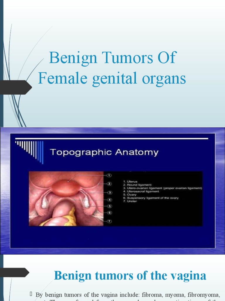 Benign Tumors of Female Genital Organs | Download Free PDF | Uterus ...