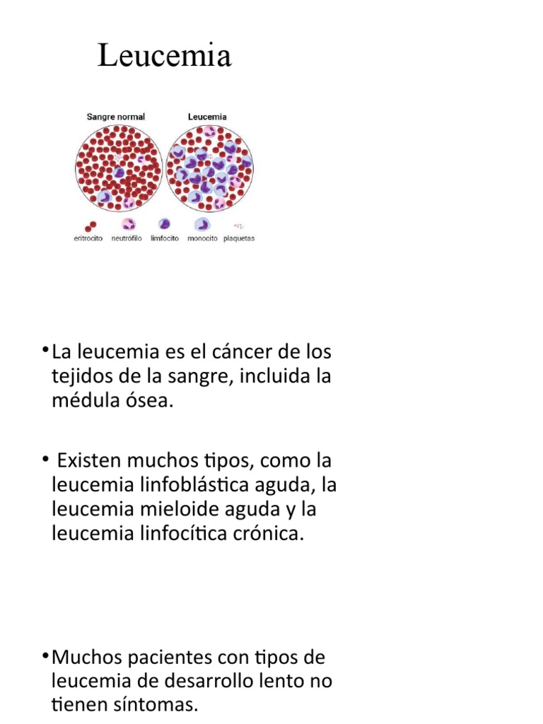 Leucemia - 1 | PDF | Leucemia | Leucocito