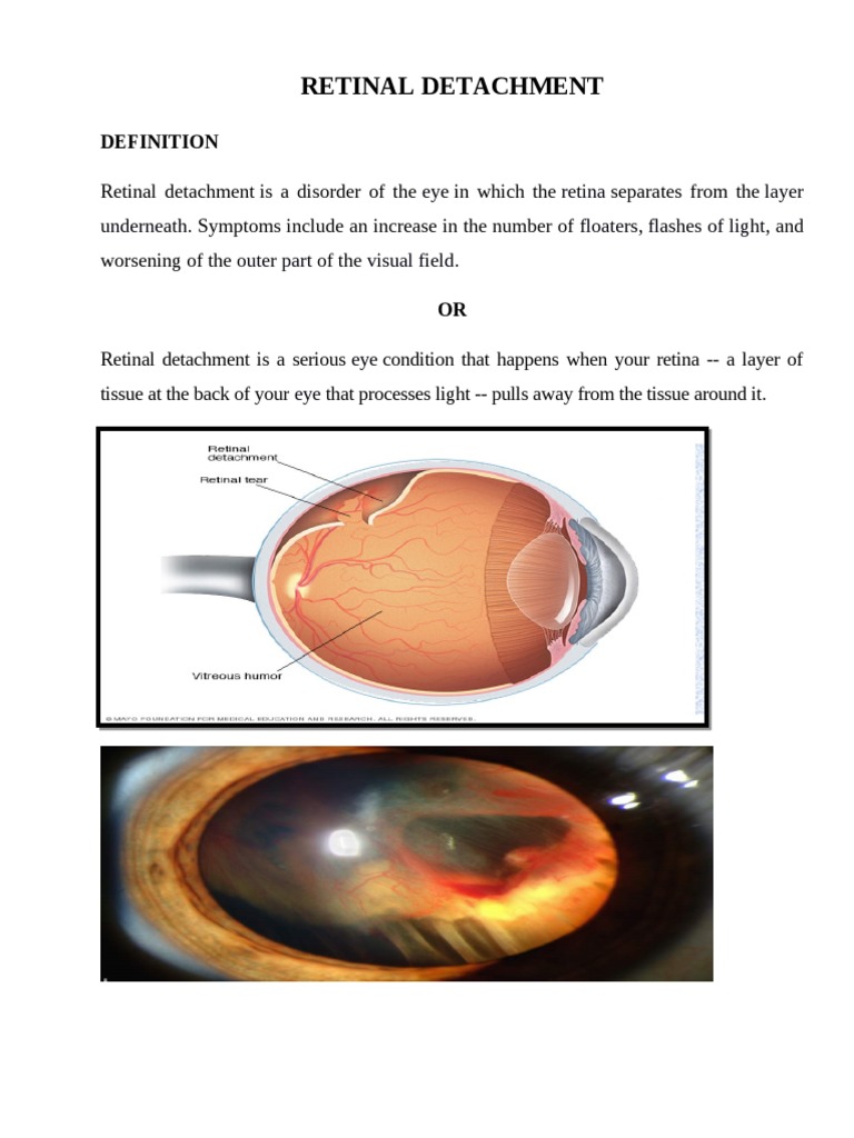 Retinal Detachment | PDF | Retina | Ophthalmology